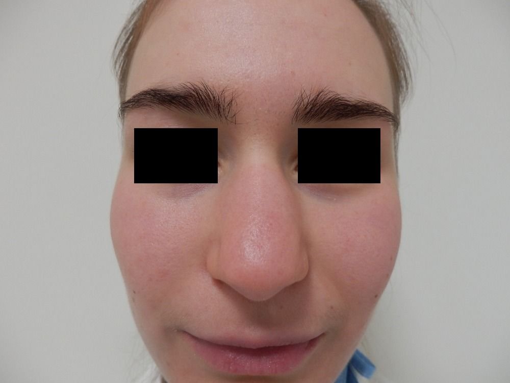 Fotogaleria - Totalna korekcja nosa